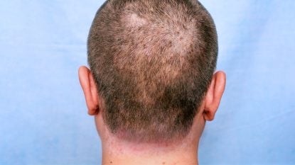 Dermatite seborreica: causas, sintomas e tratamento