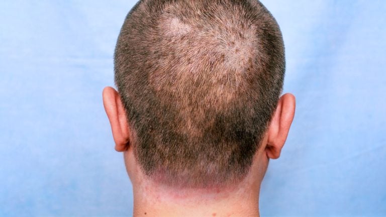 Assaduras no bebê (dermatite da fralda)