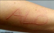 Dermografismo: o que é, sintomas, fotos e tratamento