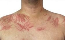 Dermografismo: o que é, sintomas, fotos e tratamento