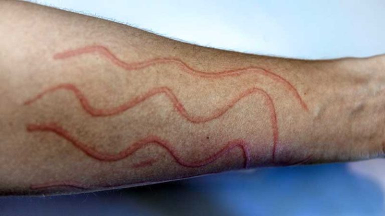 Dermografismo: qué es, fotos, síntomas y tratamiento