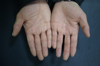 Fotos de disidrose (eczema disidrótico) | MD.Saúde