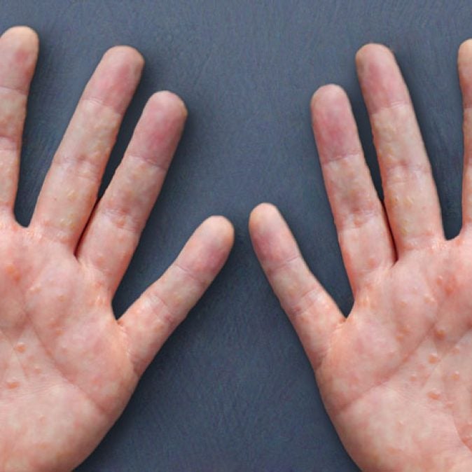 Eczema Bumps On Fingers