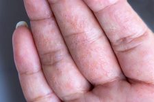 Photos of Dyshidrosis (Dyshidrotic Eczema)