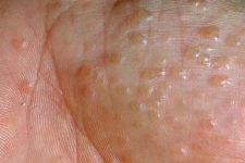 Photos of Dyshidrosis (Dyshidrotic Eczema)