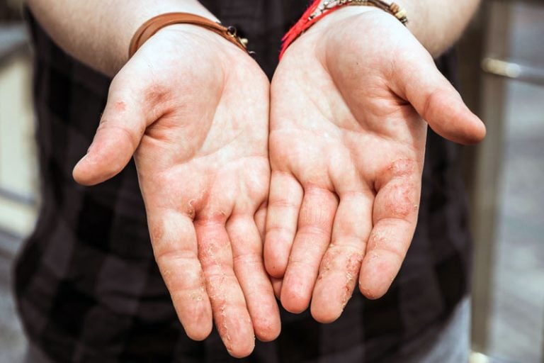 FOTOS: Disidrose (eczema disidrótico)