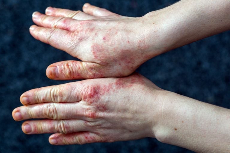 Photos of Dyshidrosis (Dyshidrotic Eczema)