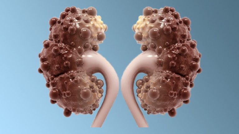 Rins policísticos | Causas, sintomas e tratamento