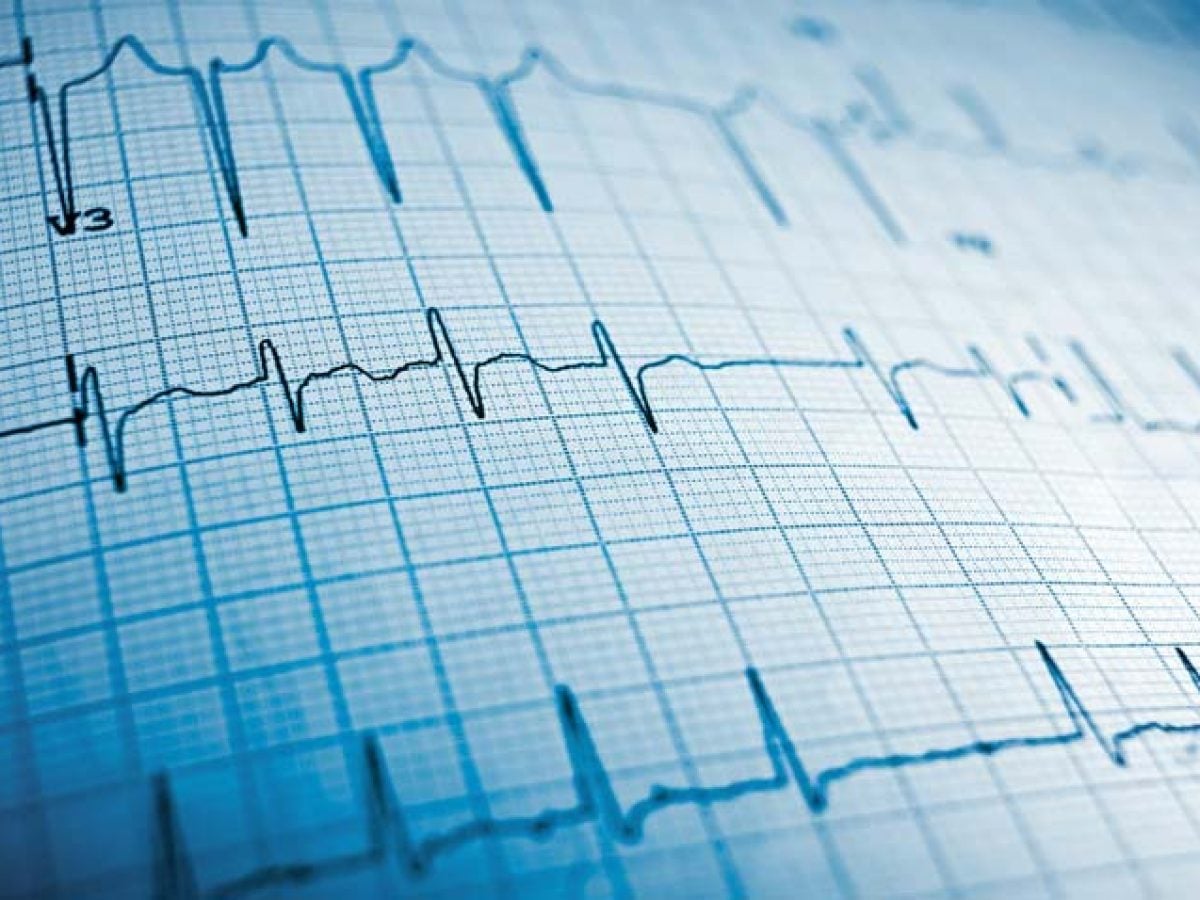 Leitura Normal De Ecg