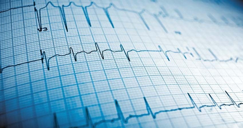 ELETROCARDIOGRAMA (ECG) - Entenda os resultados mais comuns | MD.Saúde