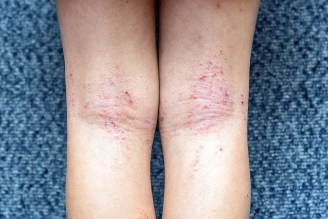 6 tipos de eczema (eccema): qué es, síntomas y tratamiento | MD.Saúde