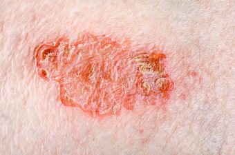 Eccema numular: qué es, síntomas y tratamiento | MD.Saúde
