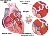 ENDOCARDITE | O que é, sintomas, tratamento e profilaxia