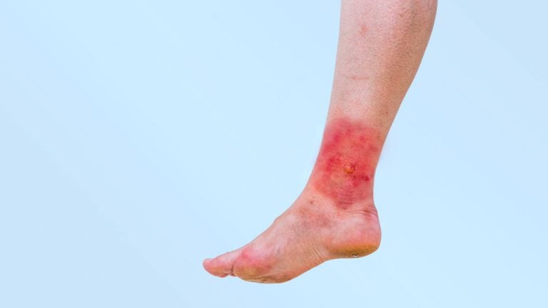 Dermatitis atópica: qué es, causas, síntomas y tratamiento