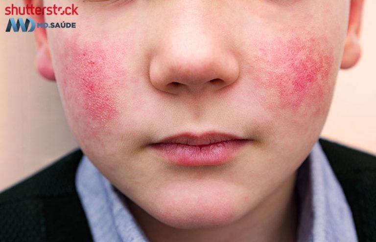 Fotos de eritema infeccioso
