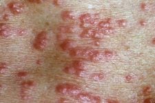 FOTOS: Sarna humana (escabiose)