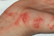 FOTOS: Sarna humana (escabiose)