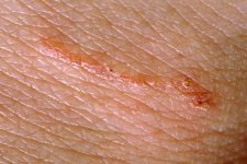 FOTOS: Sarna Humana (Escabiosis)