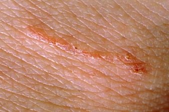FOTOS: Sarna humana (escabiose)