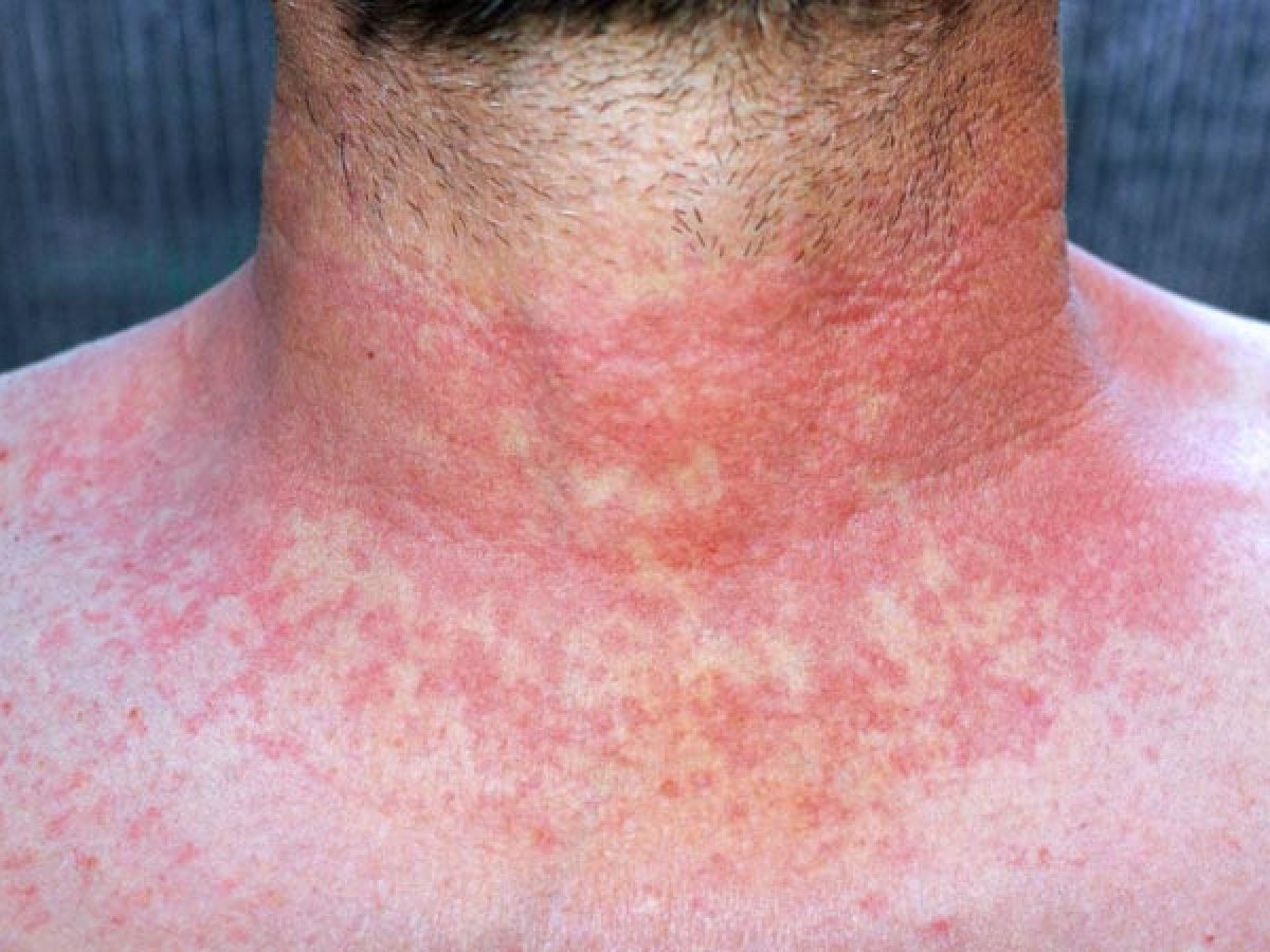 Lengua De Fresa Escarlatina