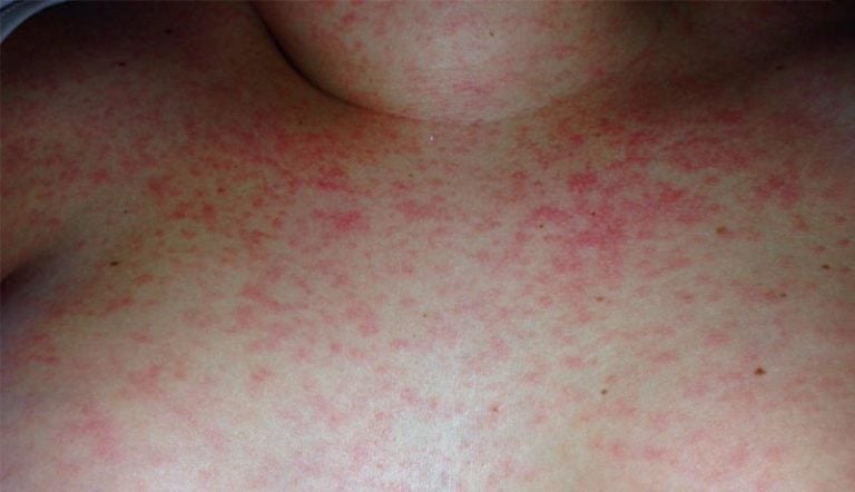 Faringite Estreptocócica: o que é, sintomas e tratamento