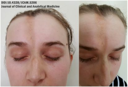 Esclerodermia | O que é, causas, sintomas e tratamento