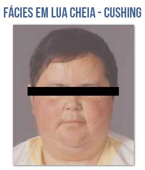 GLICOCORTICOIDES - Efeitos Colaterais e Indicações » MD.Saúde