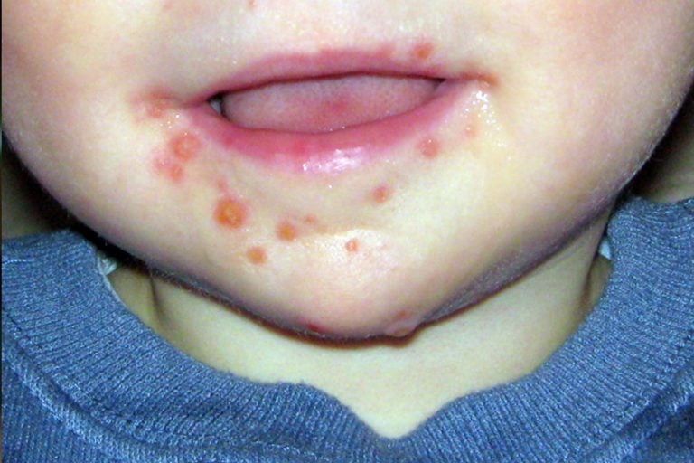 Enfermedad de manos, pies y boca: síntomas y tratamiento