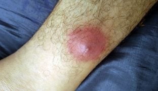 Fotos de forúnculos y carbuncos