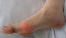 Fotos da doença gota (artrite gotosa) | MD.Saúde