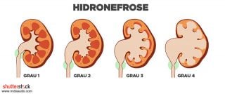 Hidronefrose: o que é, causas, sintomas e tratamento