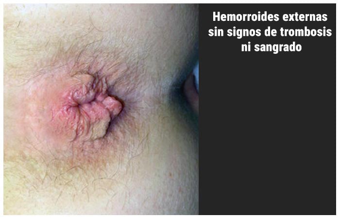 Hemorroides Externas Cura