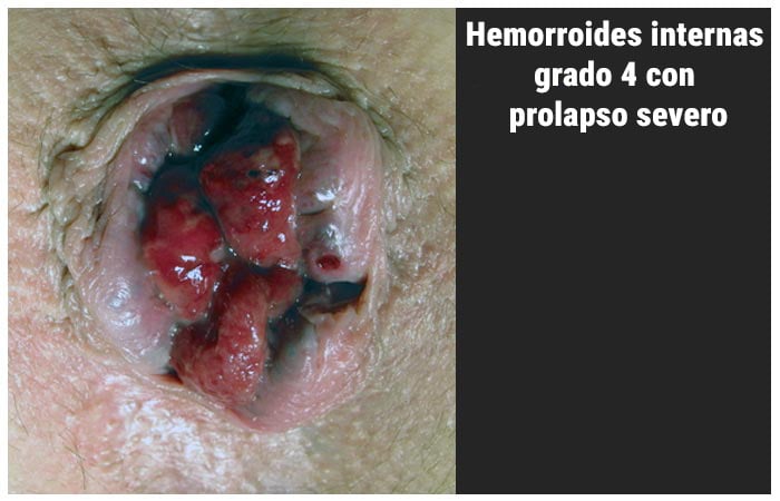 Hemorroides Externas Cura