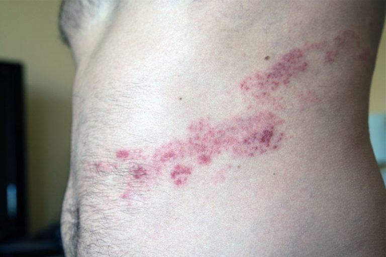 FOTOS | Herpes zóster (cobreiro)