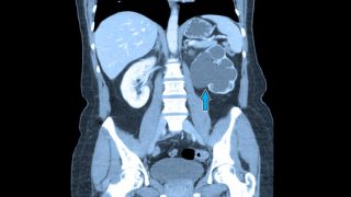 Hidronefrose: o que é, causas, sintomas e tratamento