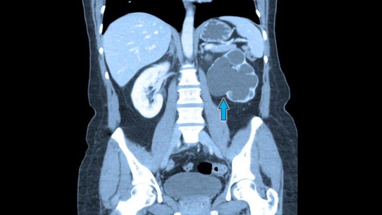 Nefrite intersticial: o que é, causas e tratamento