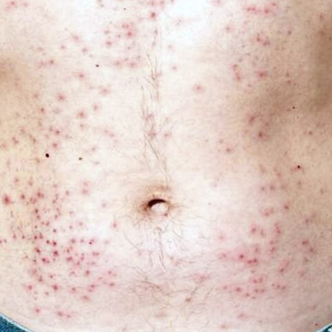 Como Identificar Erupo Cutnea Causada Pelo Hiv