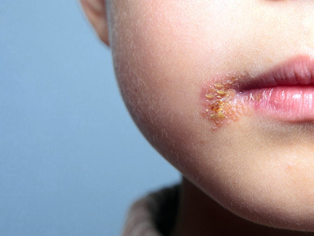Bacteria que hace heridas en la piel | Portugalessence.com