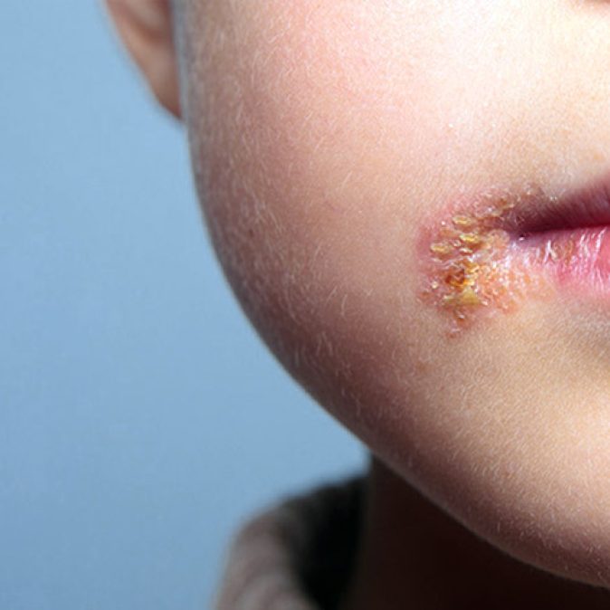 Infección Por Estafilococo