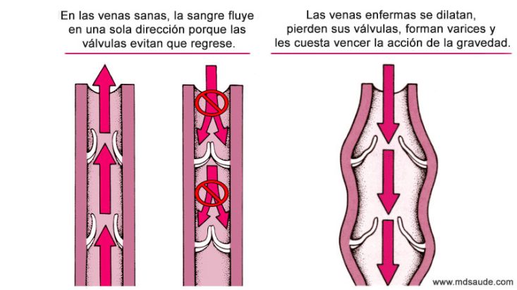 V rices En Las Piernas Causas S ntomas Y Tratamiento V rices En Las Piernas Causas S ntomas Y Tratamiento