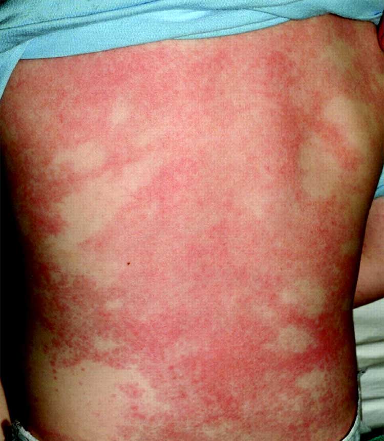 Enfermedad de Kawasaki: qué es, síntomas y tratamiento