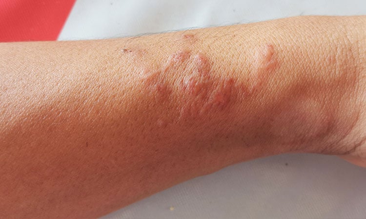 Fotos de larva migrans cutânea (bicho geográfico)