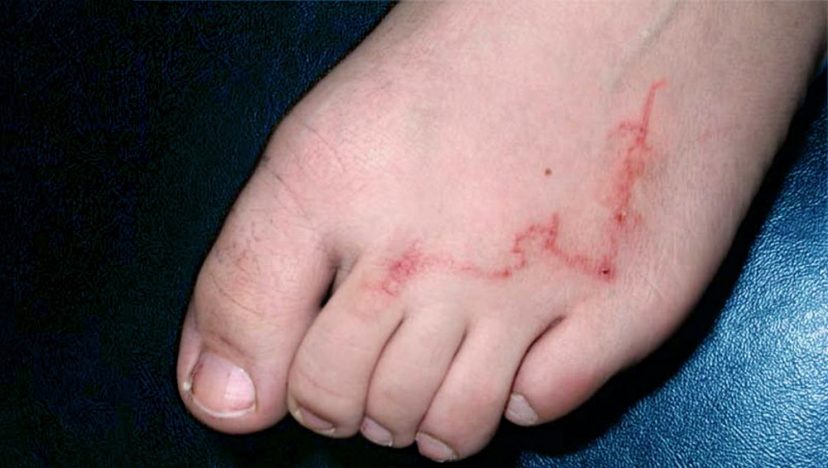 Bicho geográfico (larva migrans cutânea)