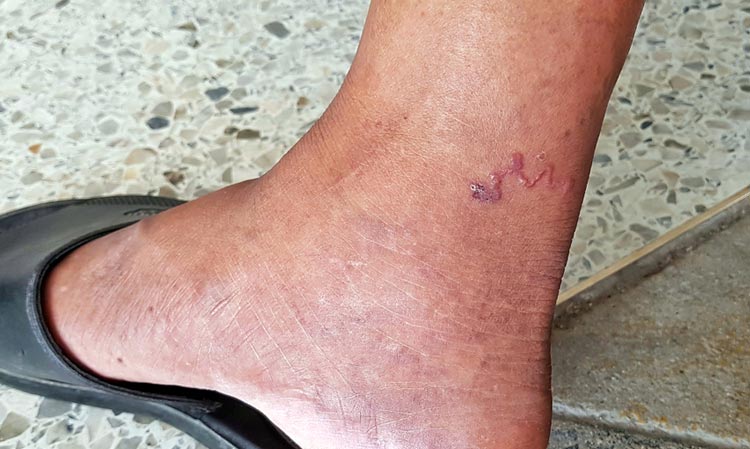 Fotos de larva migrans cutânea (bicho geográfico)