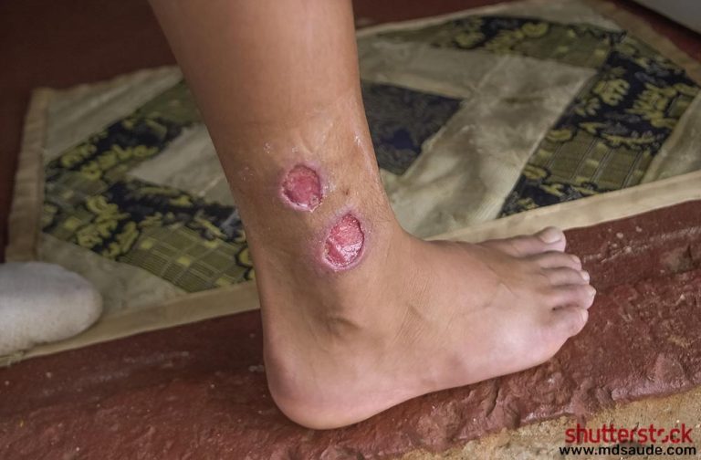 LEISHMANIOSE | Sintomas, transmissão e tratamento