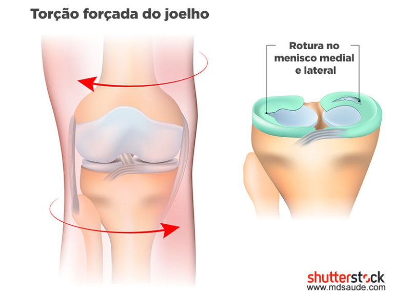Lesão do menisco: o que é, causas, sintomas e tratamento