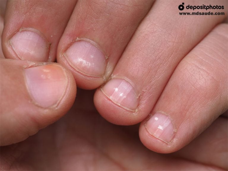Leuconiquia: manchas brancas nas unhas