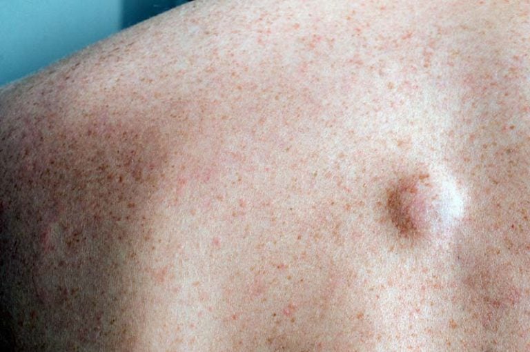Lipoma | O que é, sintomas e risco de virar câncer