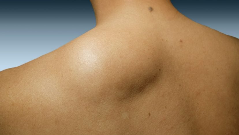 Lipoma: qué es, causas y tratamiento