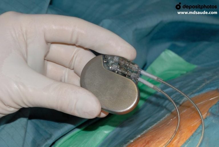 Marcapasso cardíaco | O que é, indicações e procedimento